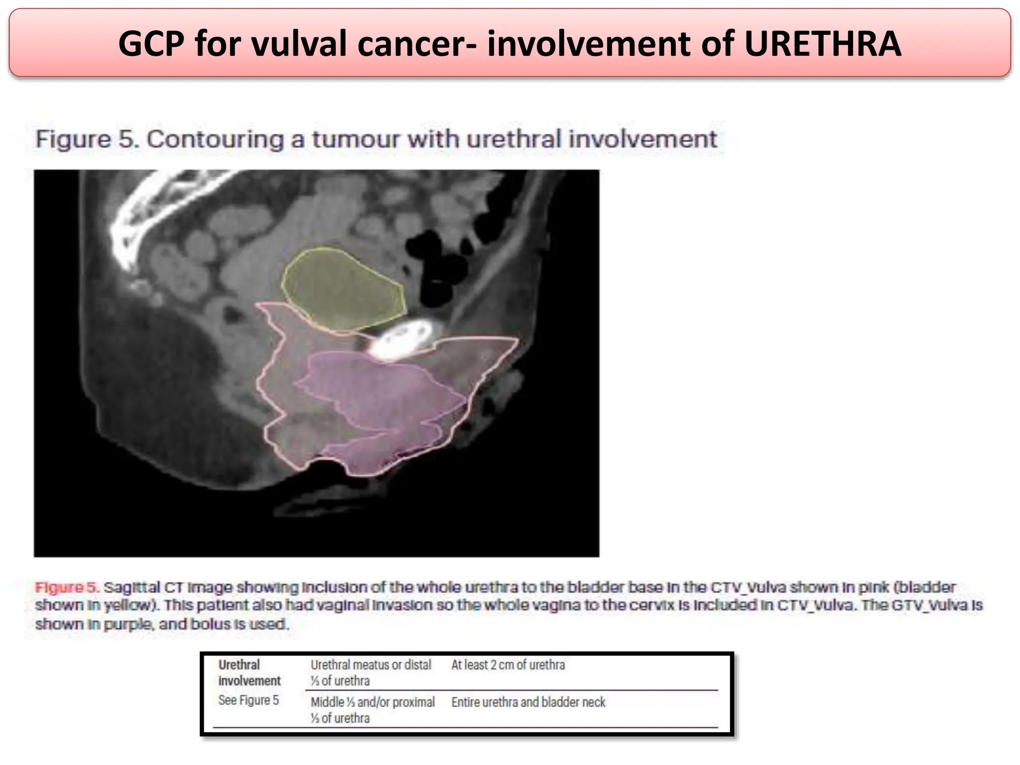 TARGET DELINEATION IN VULVAL CANCER BY DR KANHU | PPTX