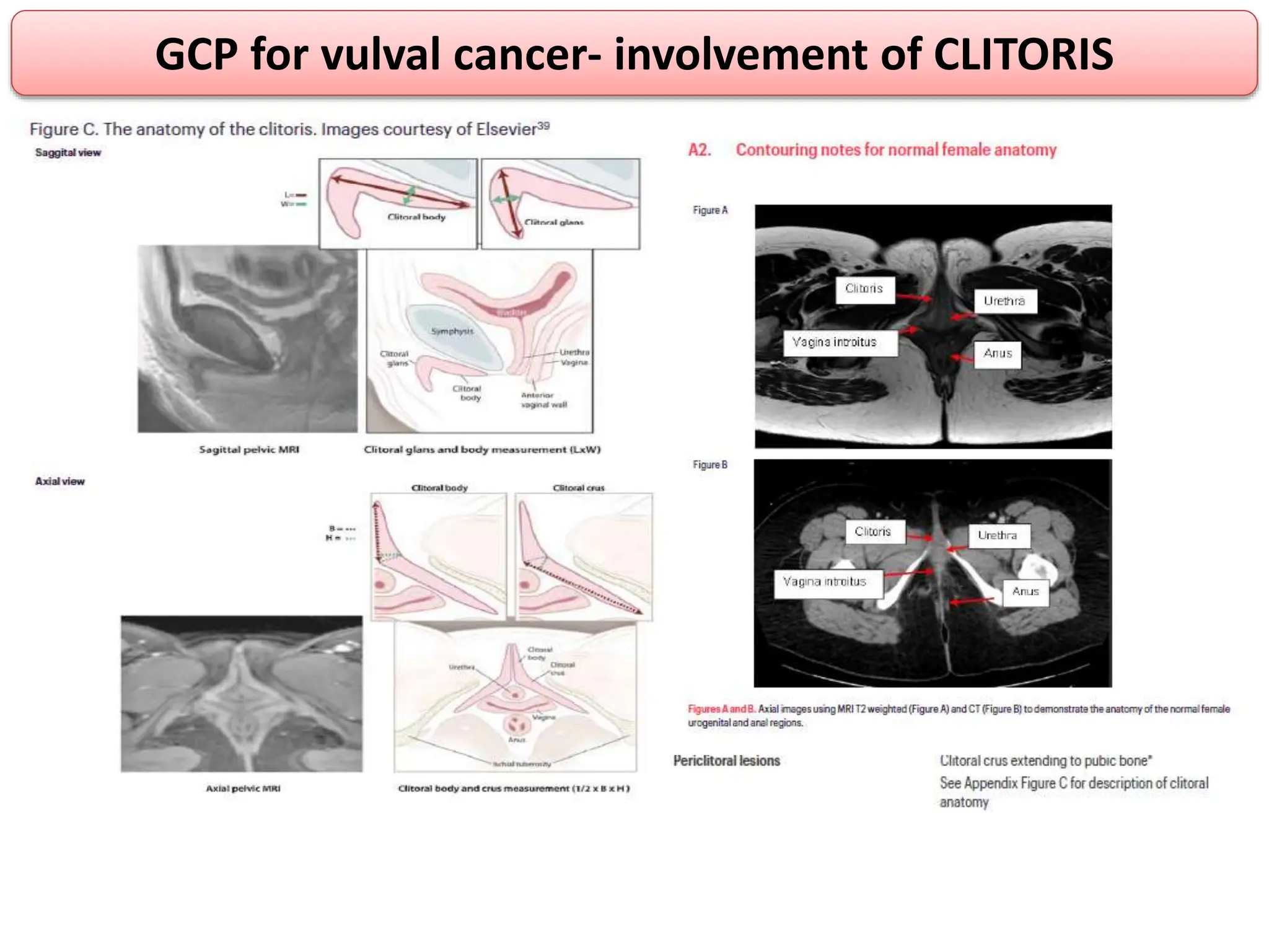 TARGET DELINEATION IN VULVAL CANCER BY DR KANHU | PPTX