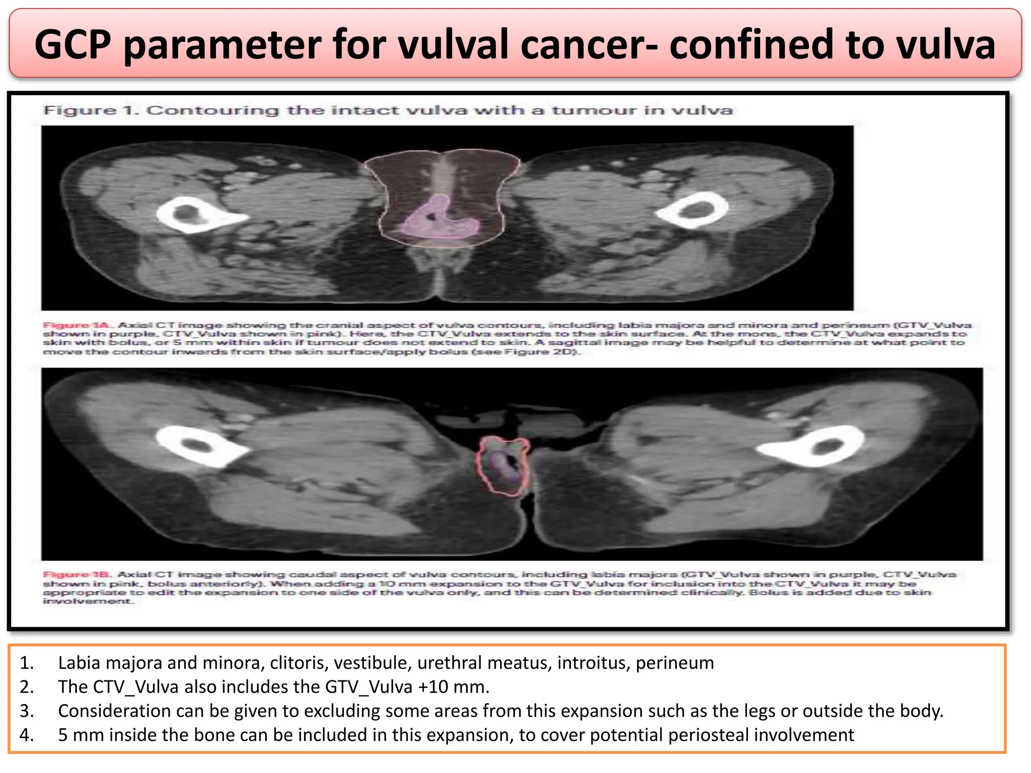TARGET DELINEATION IN VULVAL CANCER BY DR KANHU | PPTX