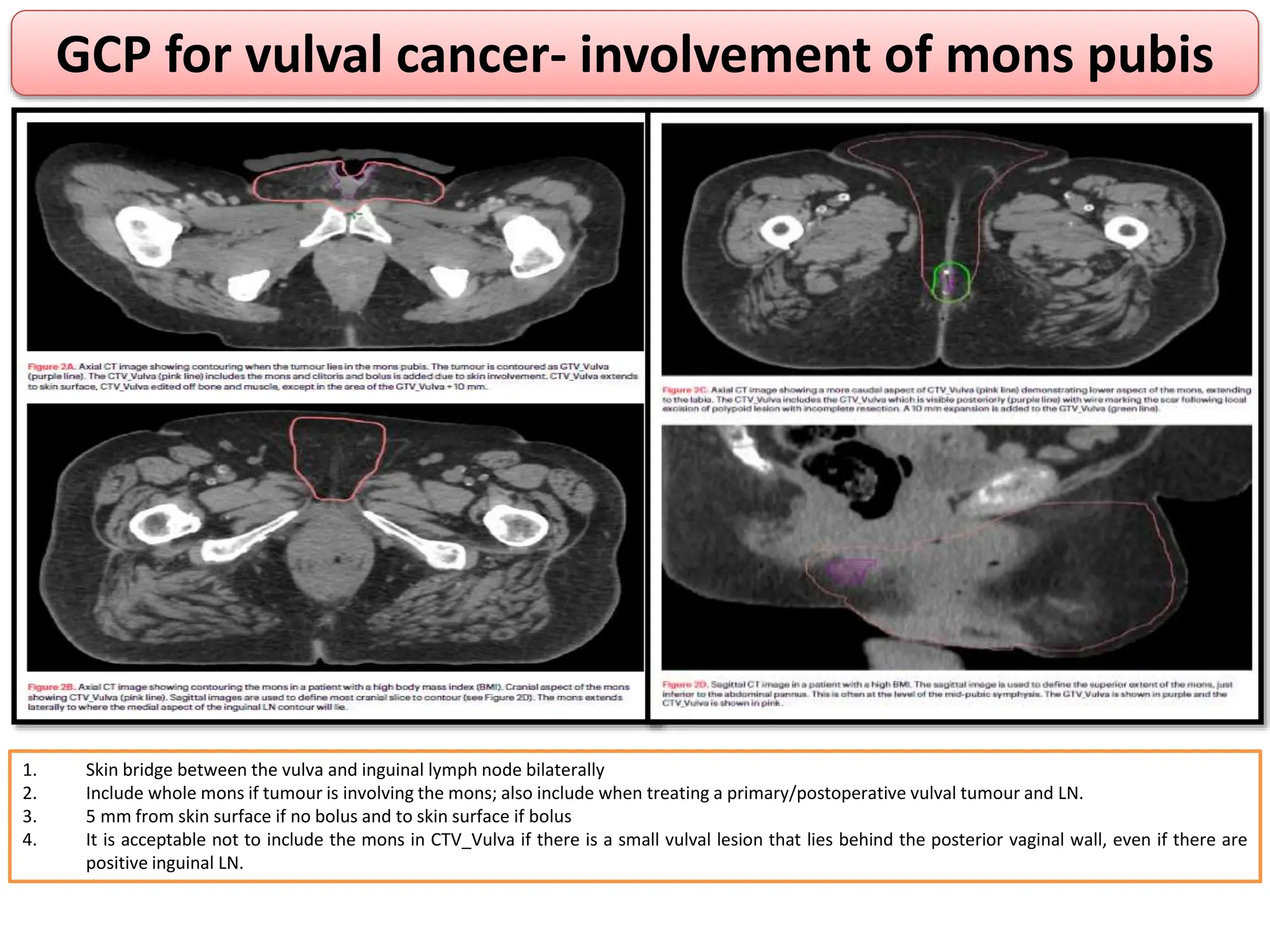 TARGET DELINEATION IN VULVAL CANCER BY DR KANHU | PPTX