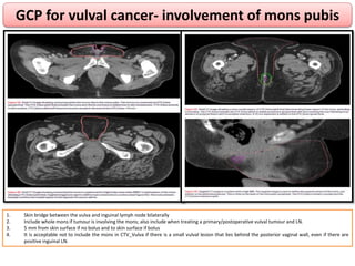 TARGET DELINEATION IN VULVAL CANCER BY DR KANHU | PPT