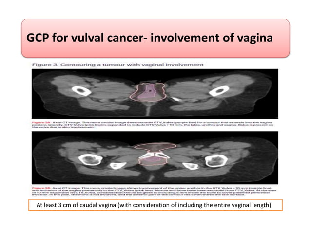 TARGET DELINEATION IN VULVAL CANCER BY DR KANHU | PPT