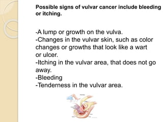 Cancer of the Vulva | PPTX