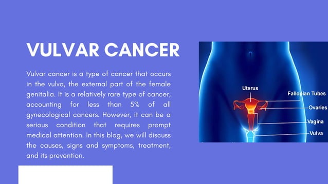 VULVAR CANCER.pptx