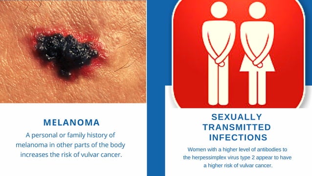 VULVAR CANCER - NORTH TEXAS GYNECOLOGIC ONCOLOGY | PPT
