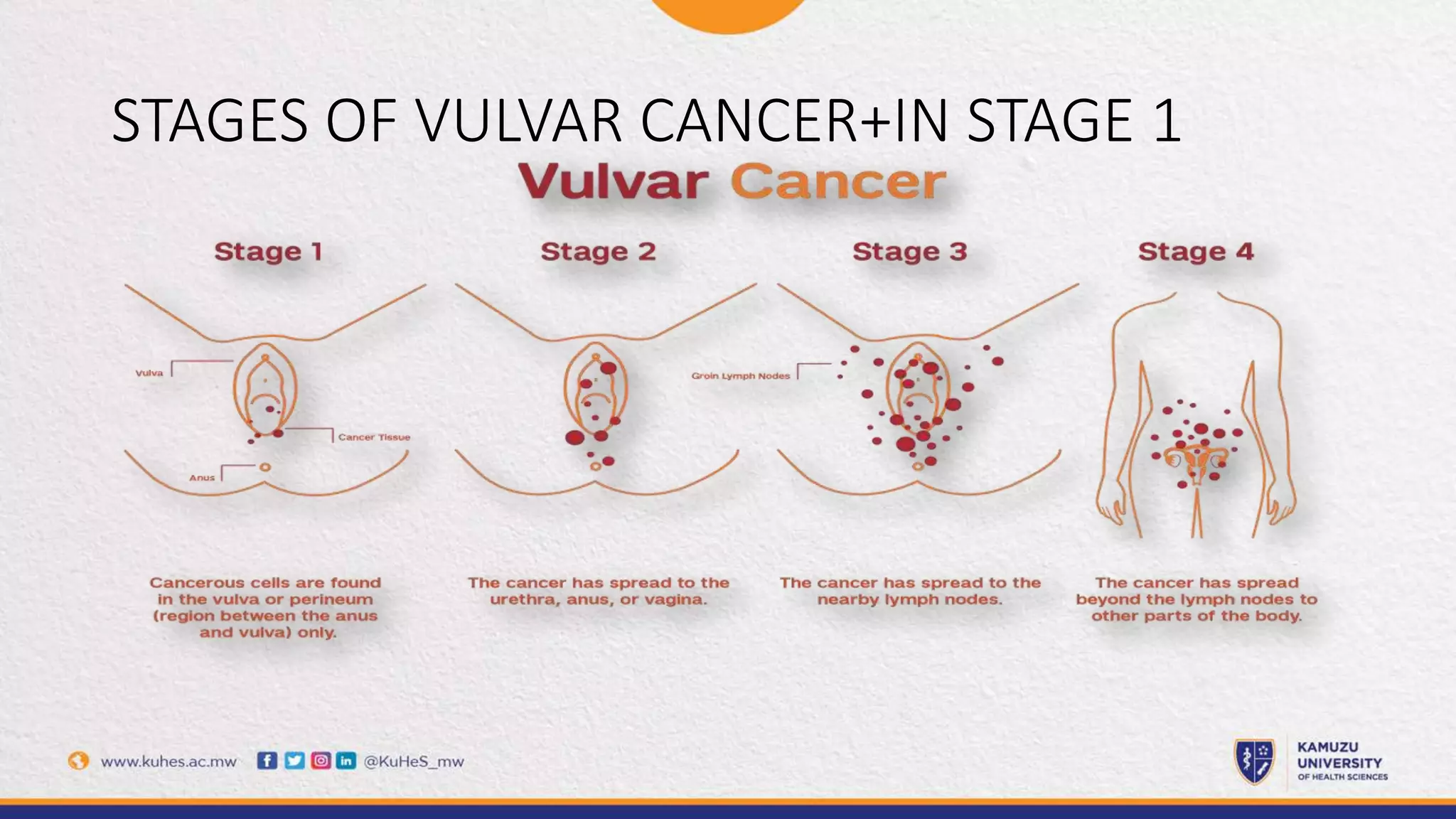 VULVAR CANCER group 4.pptx