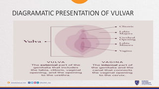 VULVAR CANCER group 4.pptx