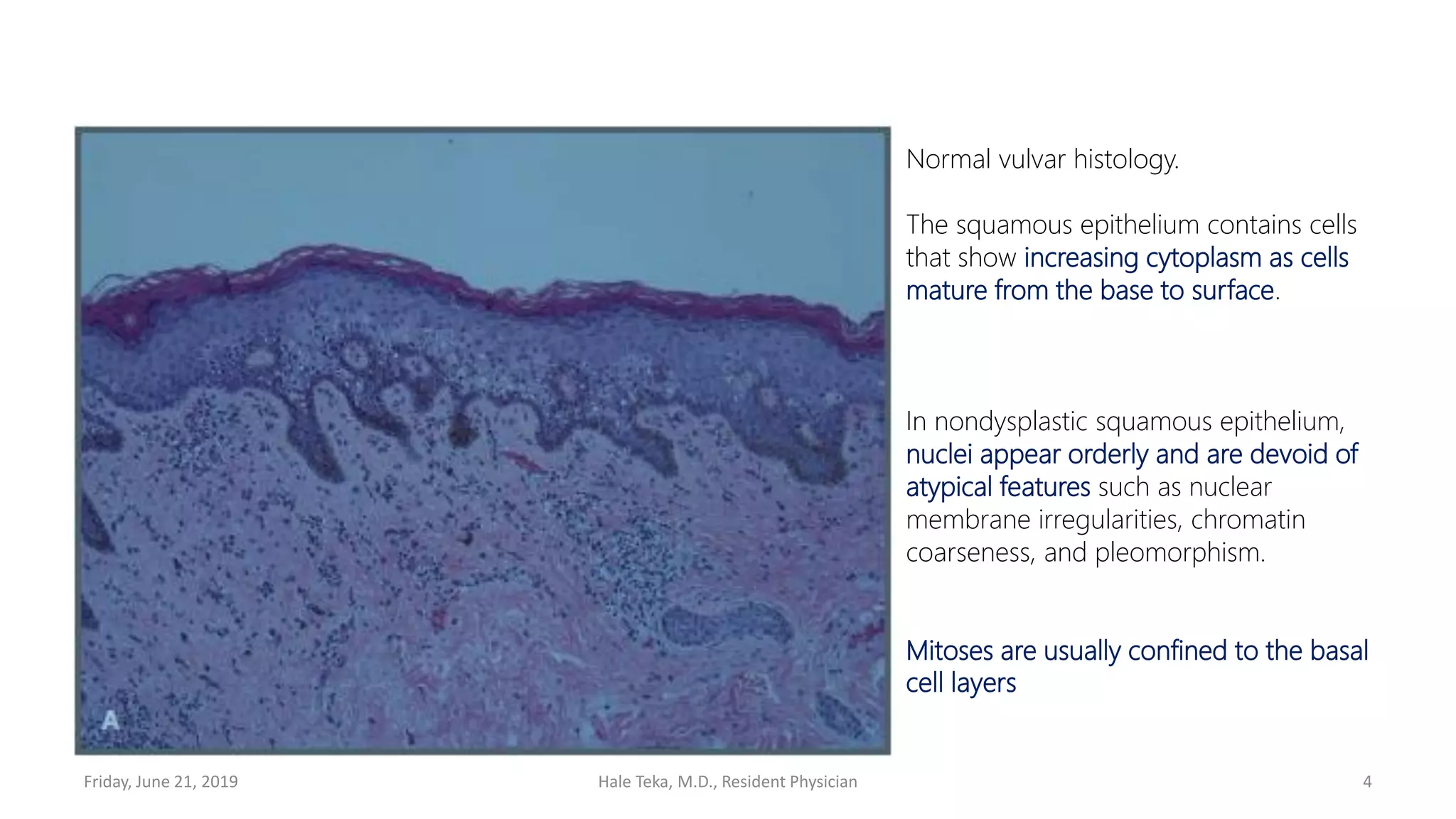 Vulvar cancer (preinvasive and invasive) | PDF