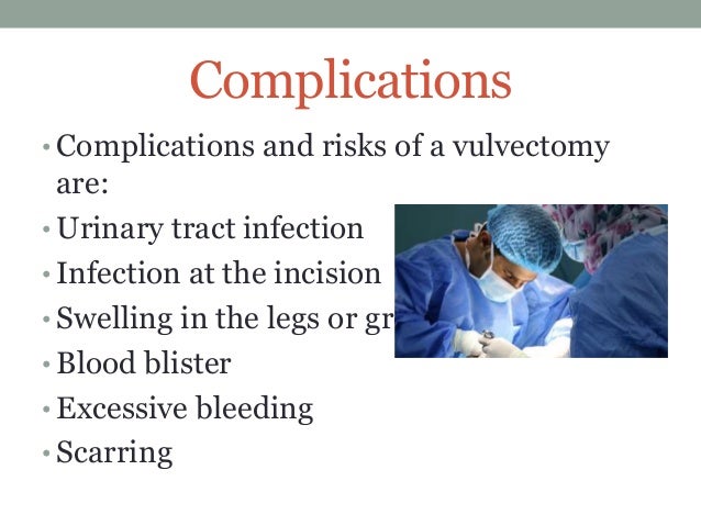 Vulvectomy | PPTX