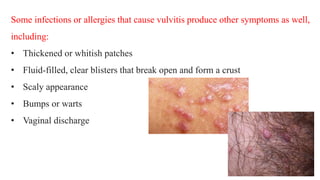 Vulvitis | PPTX