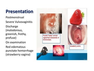 Vulvovaginitis In Children