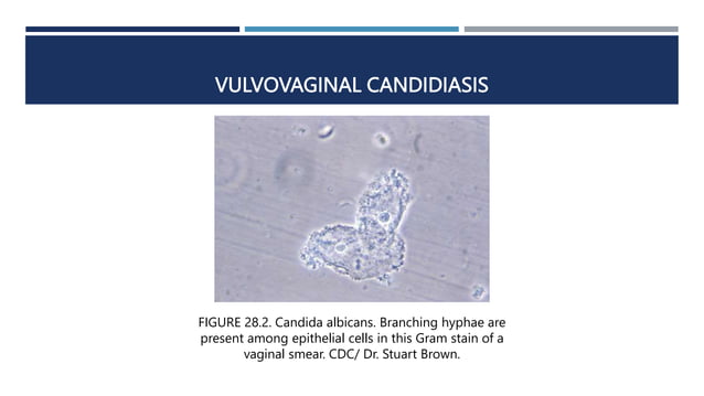 VULVOVAGINITIS - Presentation.pptx