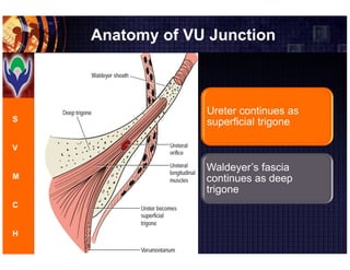 Vesicoureteric Reflux- commonest cause for pediatric UTI | PDF