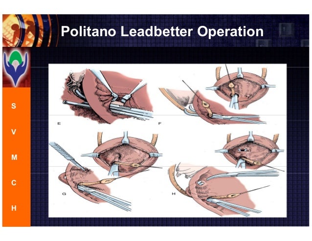 Vesicoureteric Reflux- commonest cause for pediatric UTI
