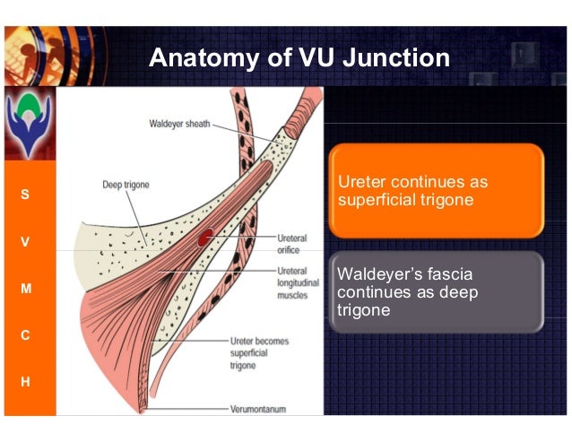 Vesicoureteric Reflux- commonest cause for pediatric UTI