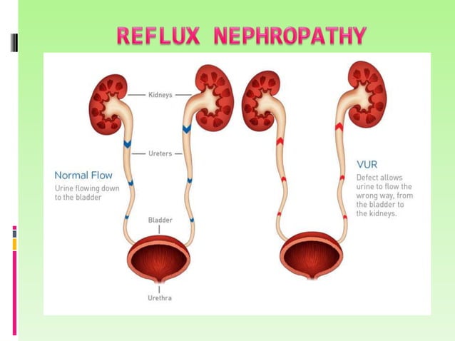 VUR & Reflux Nephropathy.pptx