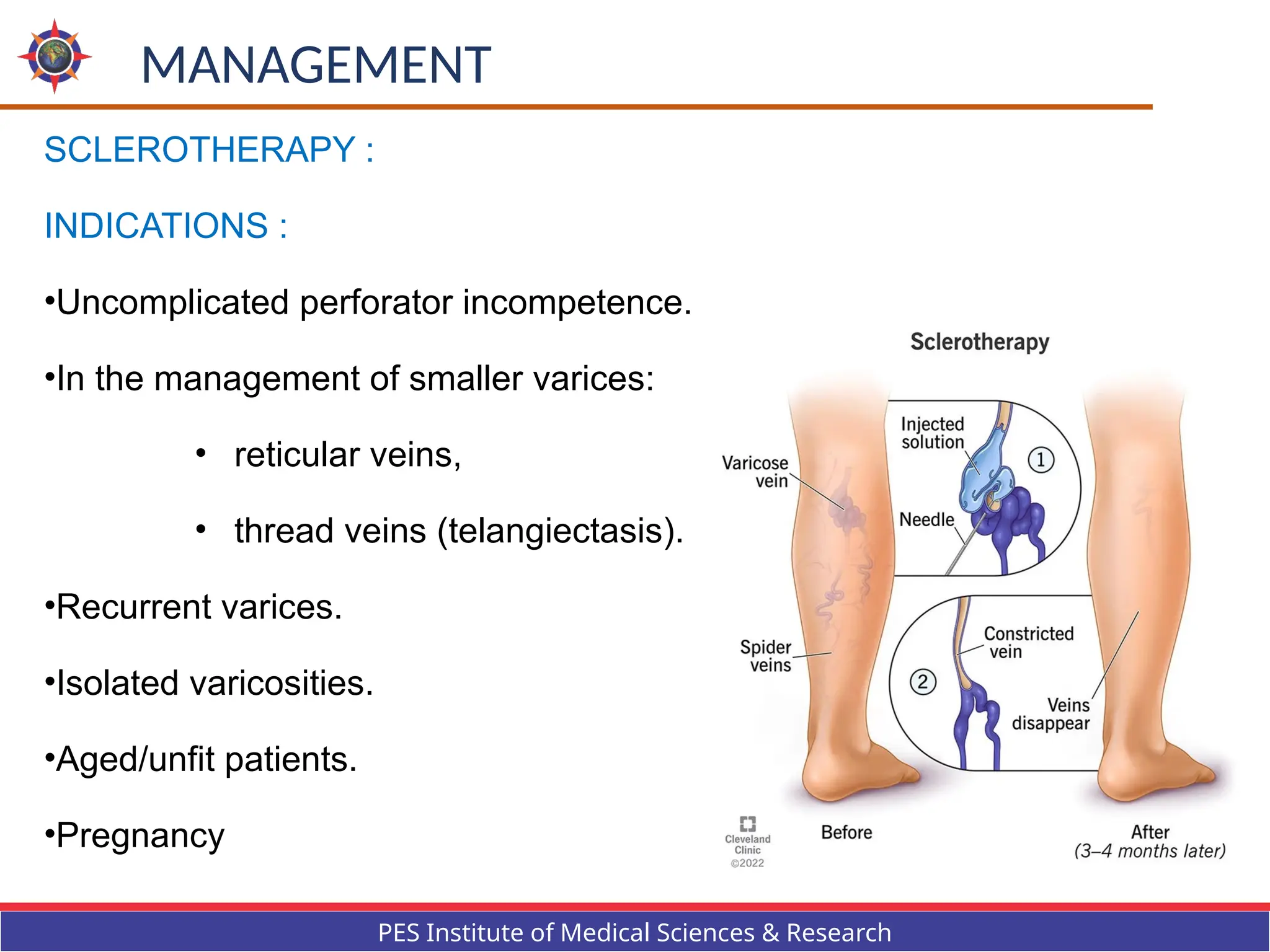 Management of varicose veins for general surgeons | PPTX