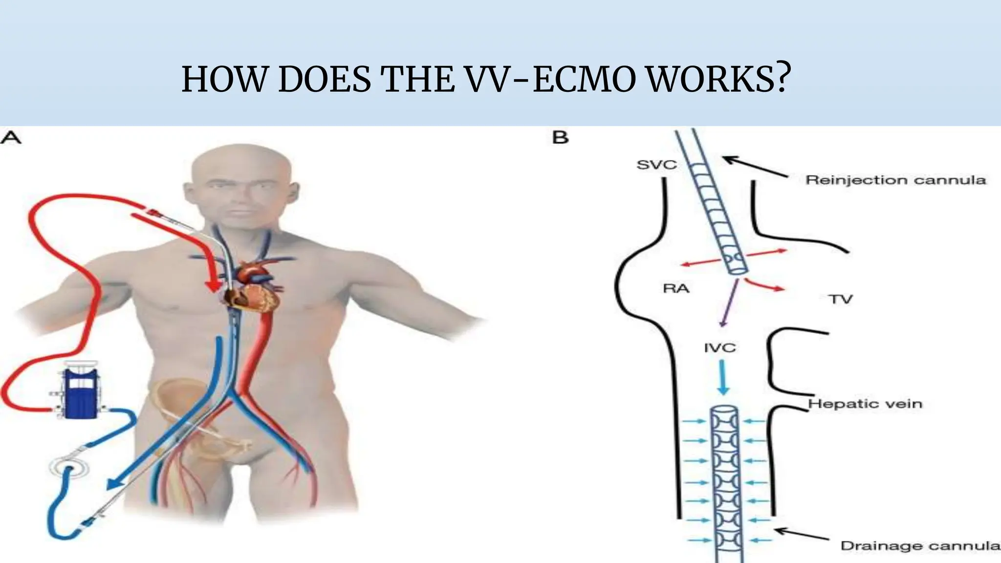 Veno-venous Extracorporeal membrane oxygenation (ECMO).pptx
