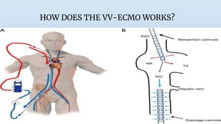 Veno-venous Extracorporeal membrane oxygenation (ECMO).pptx