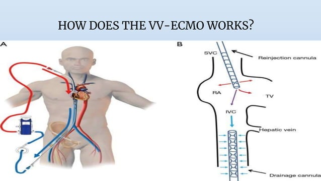 Veno-venous Extracorporeal membrane oxygenation (ECMO).pptx