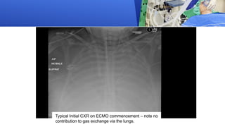 Venovenous Extracorporeal membrane oxygenation.pptx