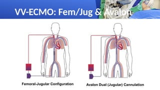 Venovenous Extracorporeal membrane oxygenation.pptx
