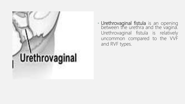Obstetric fistula | PPTX | Pregnancy | Reproductive Health