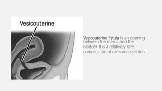 Obstetric fistula | PPTX