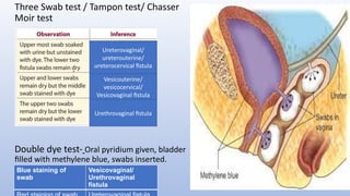vEsicovaginal fistula vvf class edited.pptx