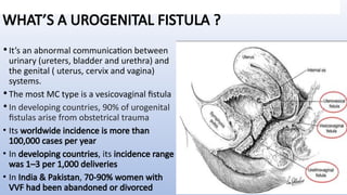vEsicovaginal fistula vvf class edited.pptx