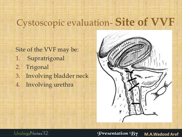 Vesicovaginal fistula evaluation