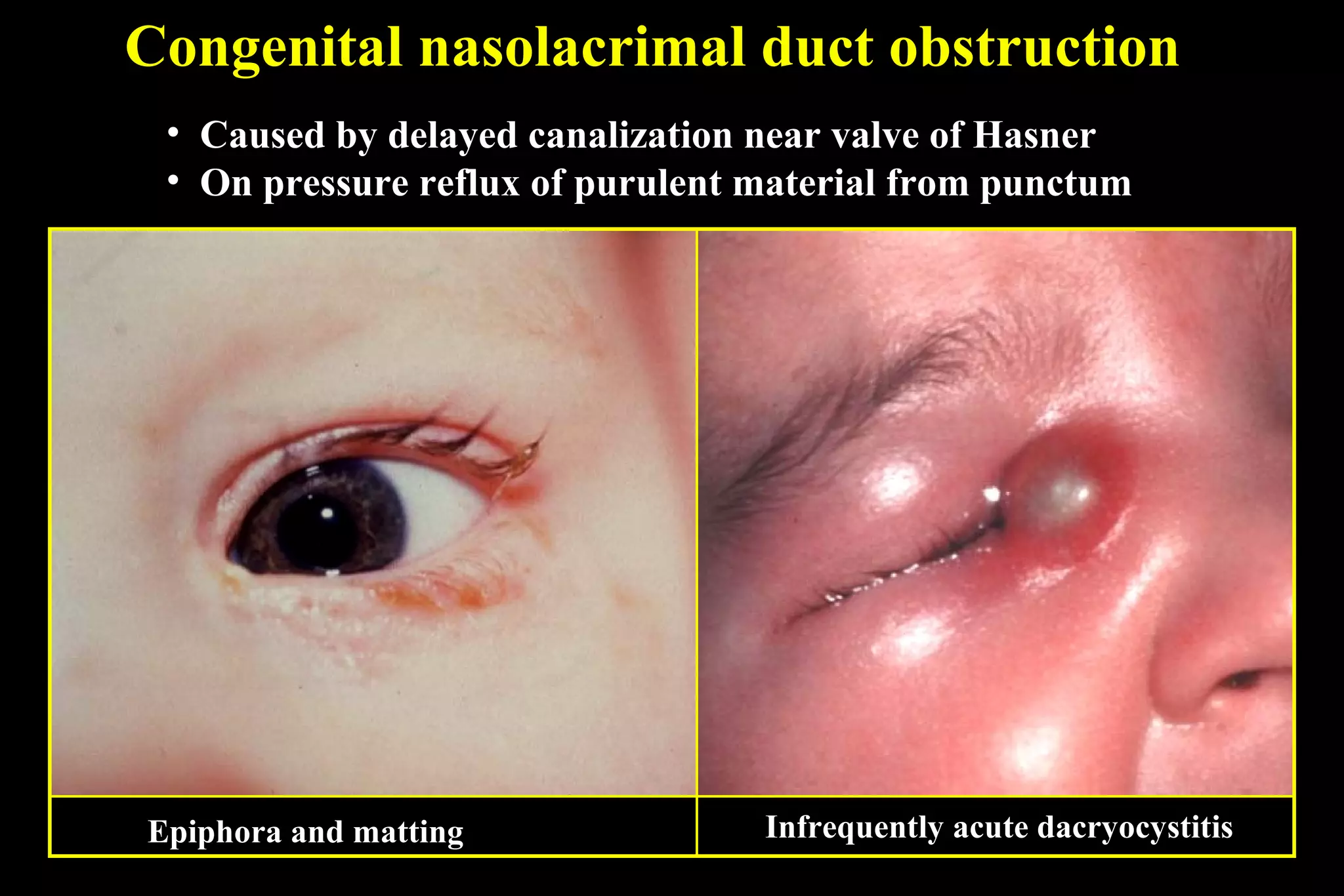 08 Infection Lacrimal Ppt