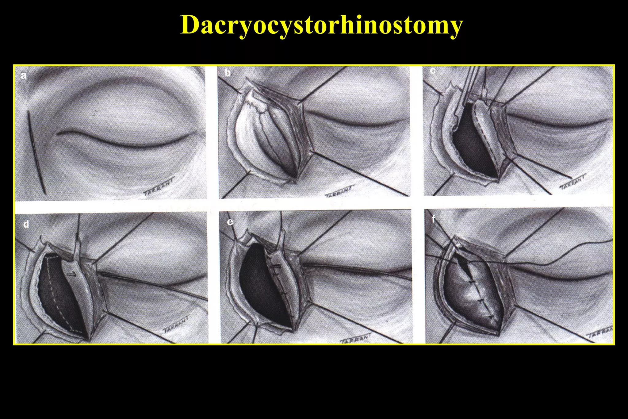 08 Infection Lacrimal Ppt
