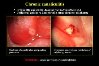 08 infection lacrimal | PPT