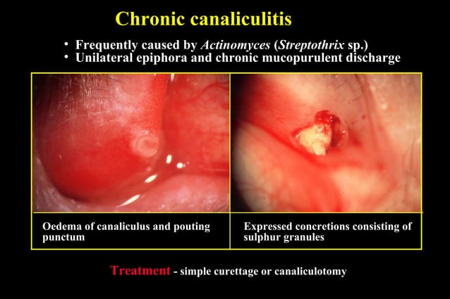 08 Infection Lacrimal Ppt