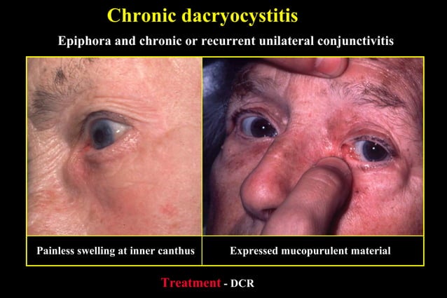 08 Infection Lacrimal Ppt