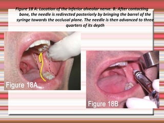 Mandibular Nerve Block - By Dr Saikat Saha | PPT