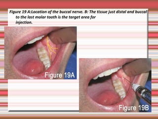 Mandibular Nerve Block - By Dr Saikat Saha | PPT