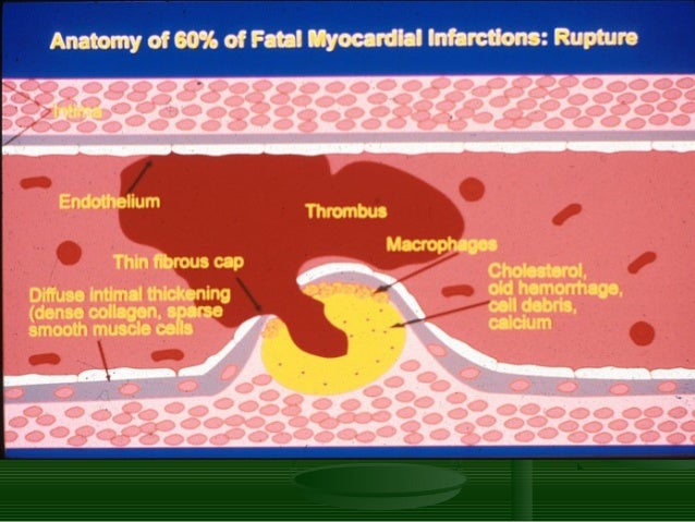 Atherosclerosis and its consequences (plaque rupture and