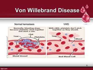 Von Willebrand Disease | PPT