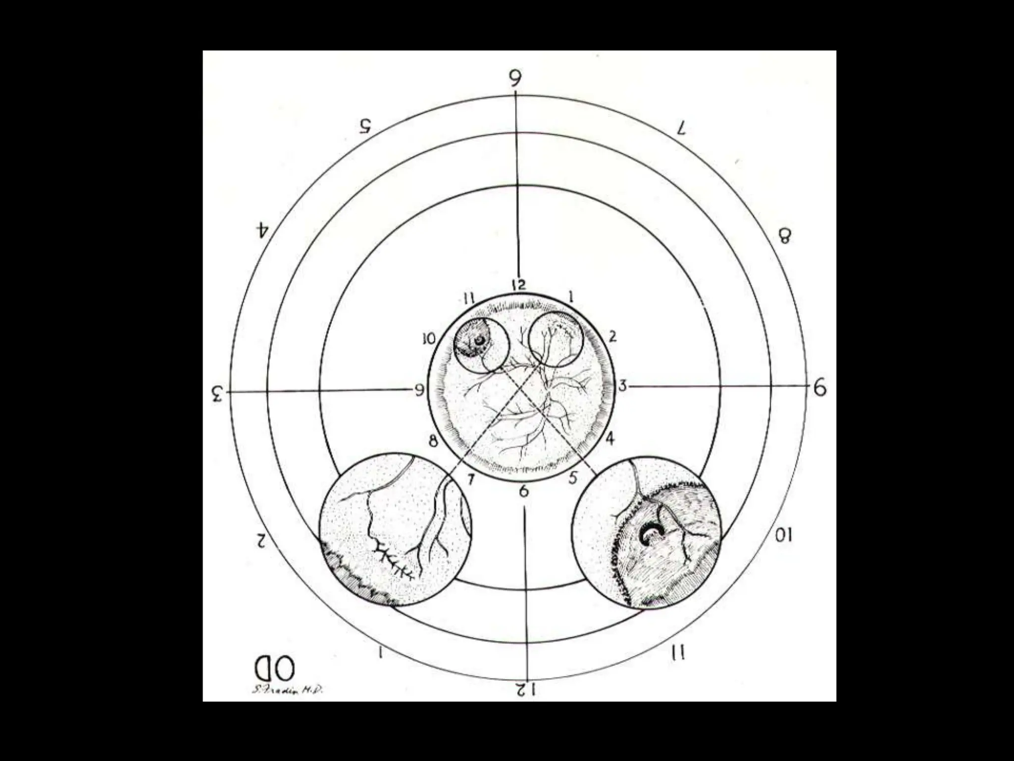 1FUNDUS_DRAWING of retina after complete examination | PPT