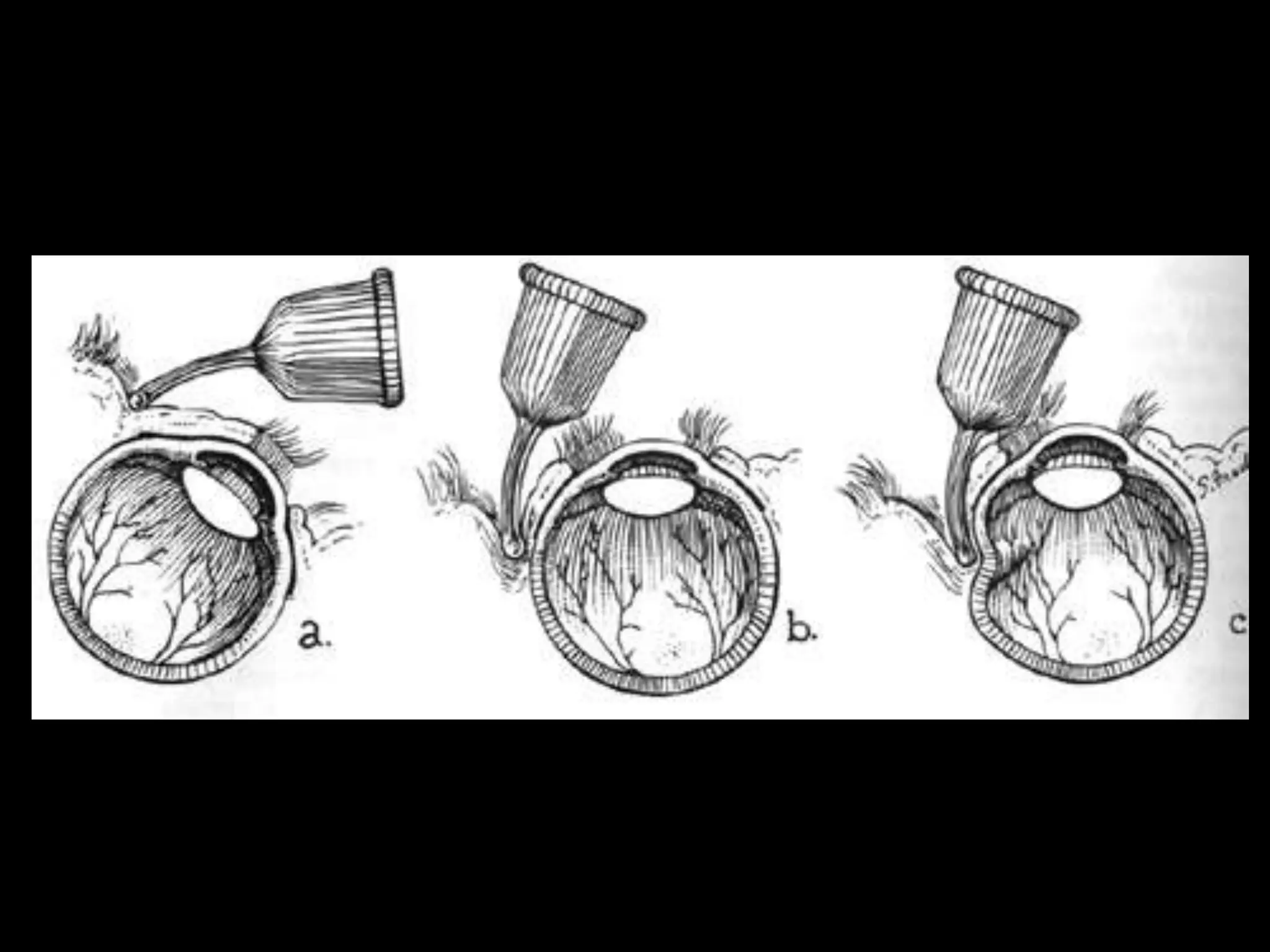 1FUNDUS_DRAWING of retina after complete examination | PPT