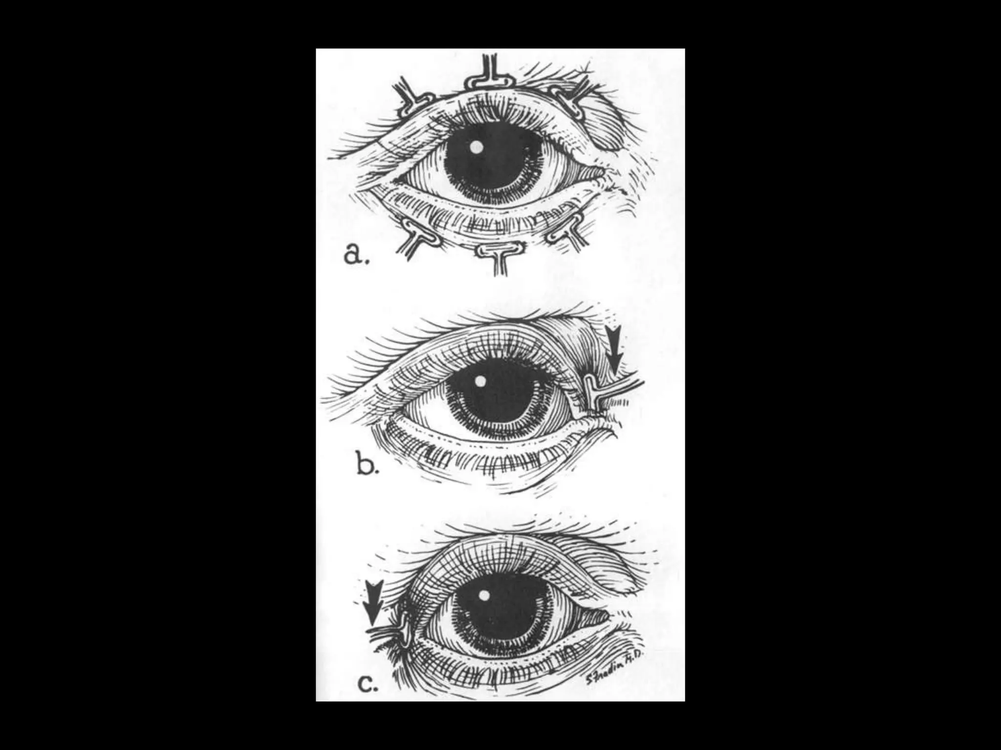 1FUNDUS_DRAWING of retina after complete examination | PPT