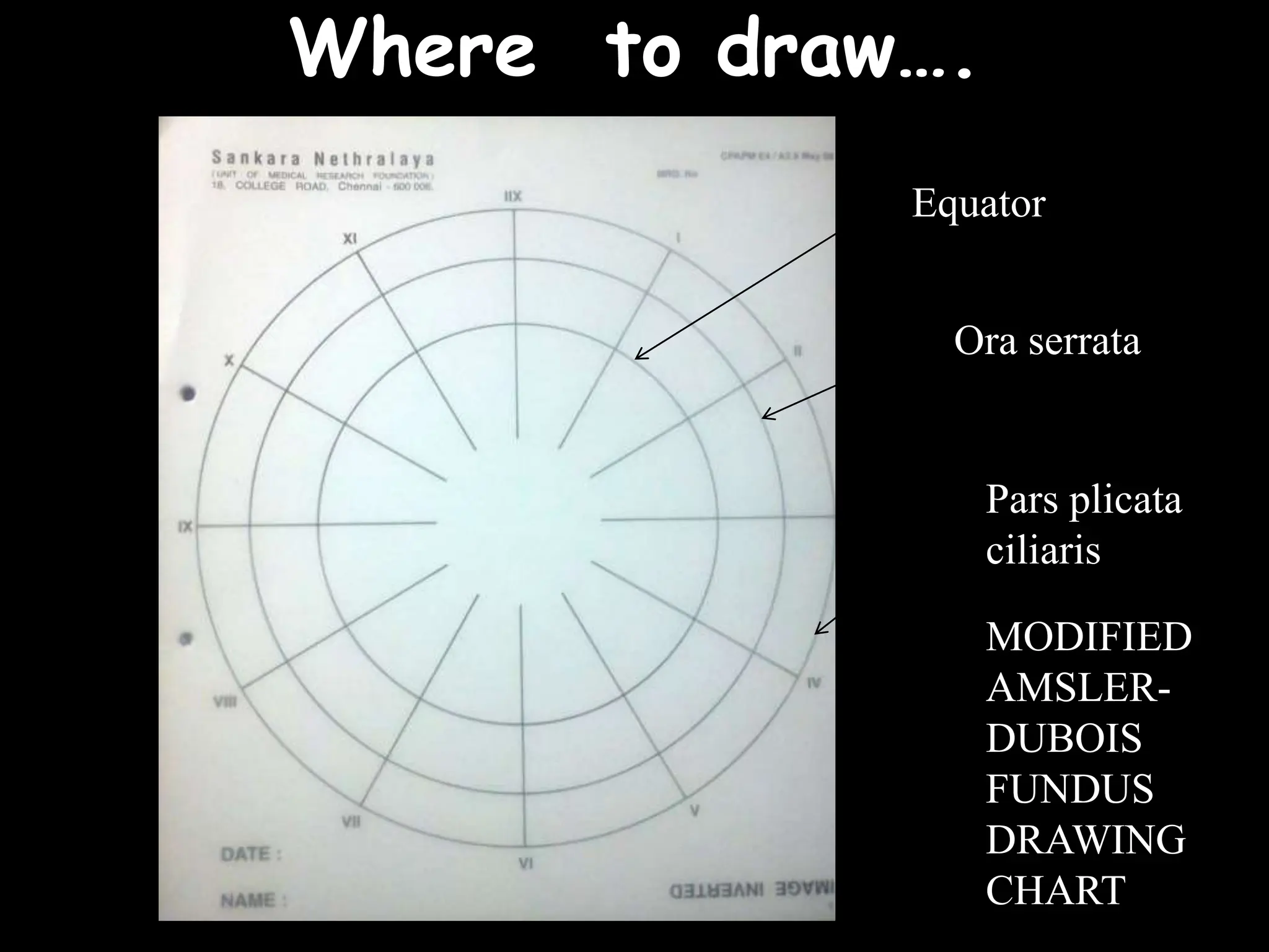 1FUNDUS_DRAWING of retina after complete examination | PPT | Eye and ...