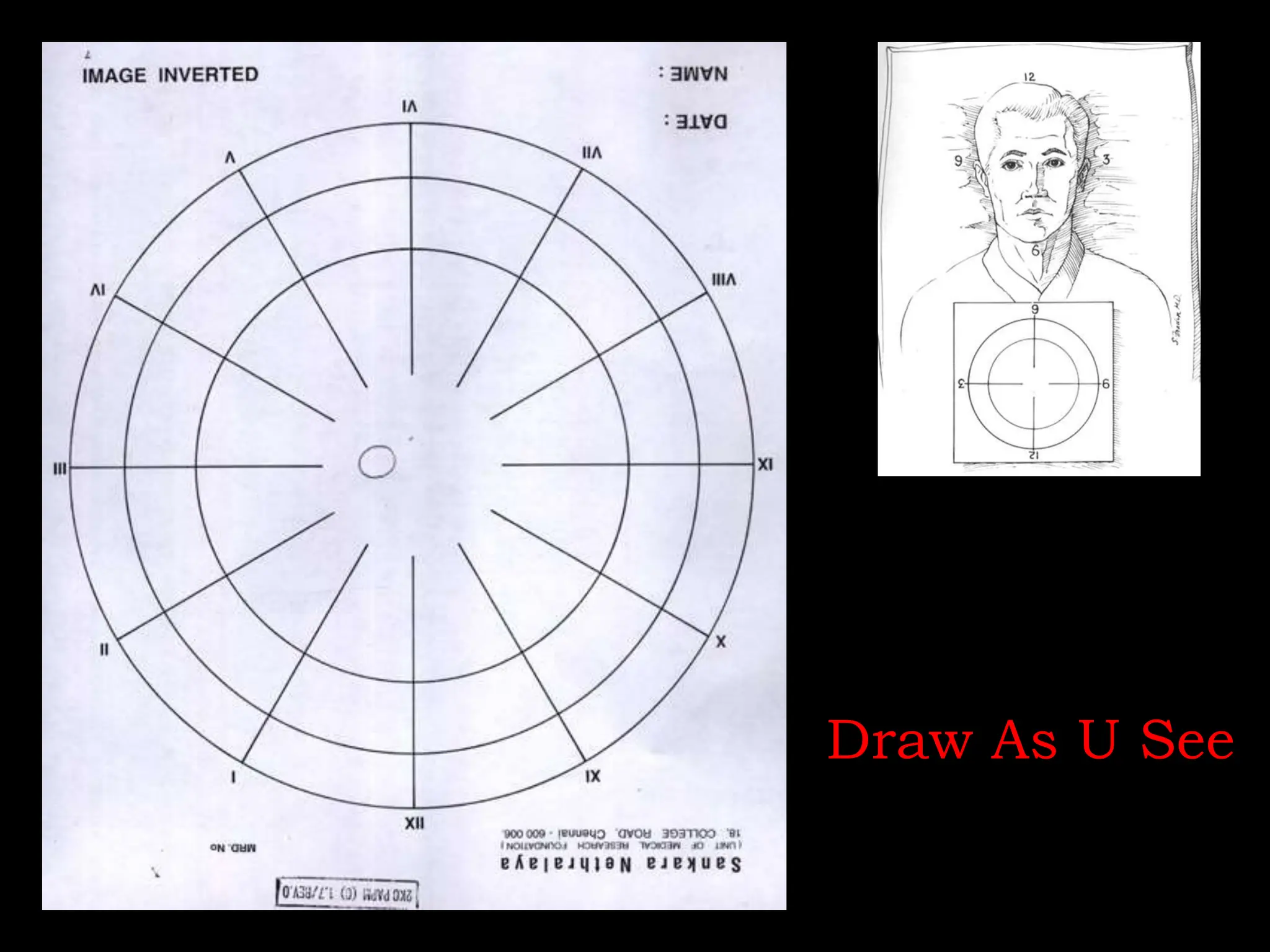 1FUNDUS_DRAWING of retina after complete examination | PPT