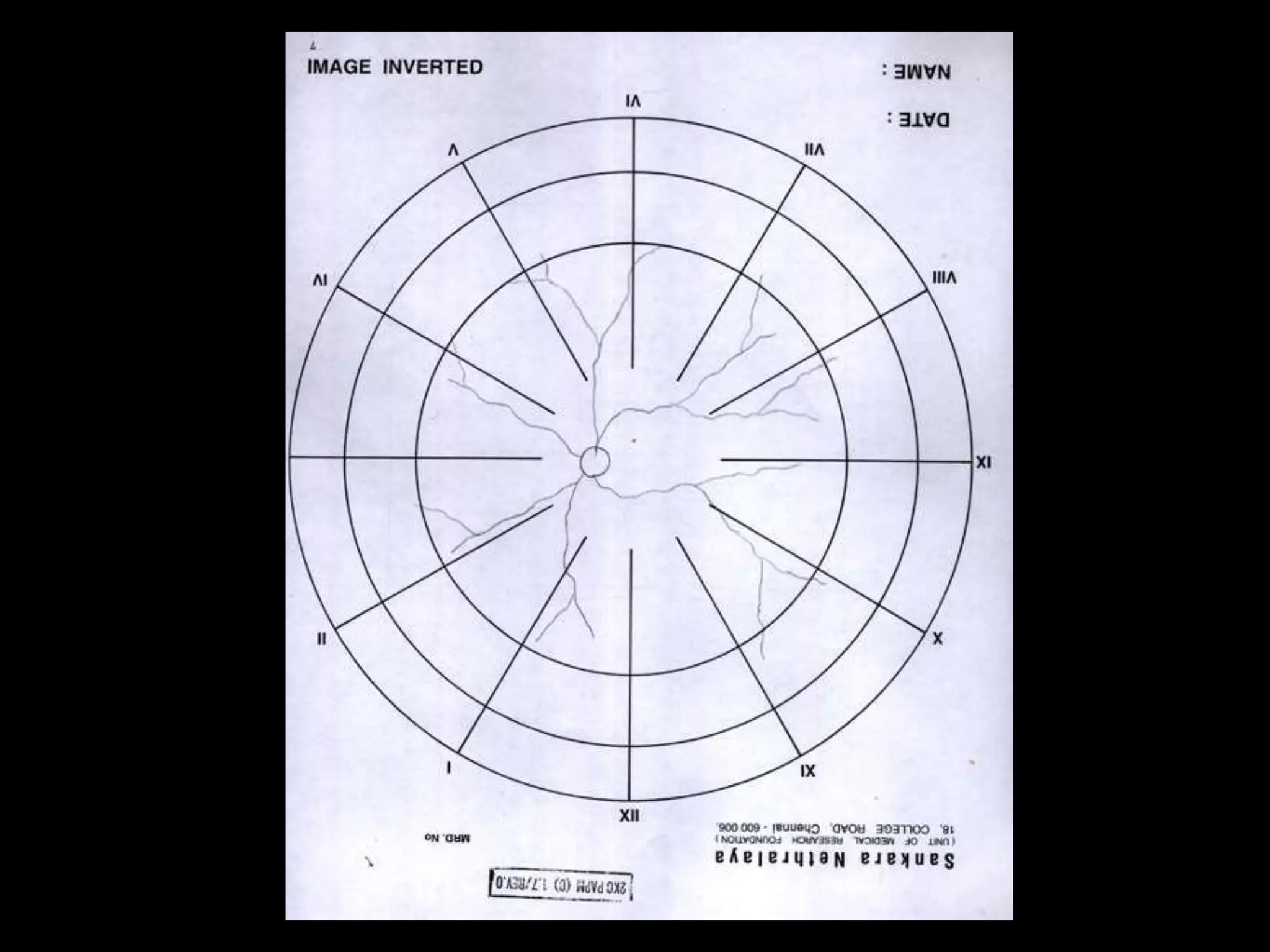 1FUNDUS_DRAWING of retina after complete examination | PPT