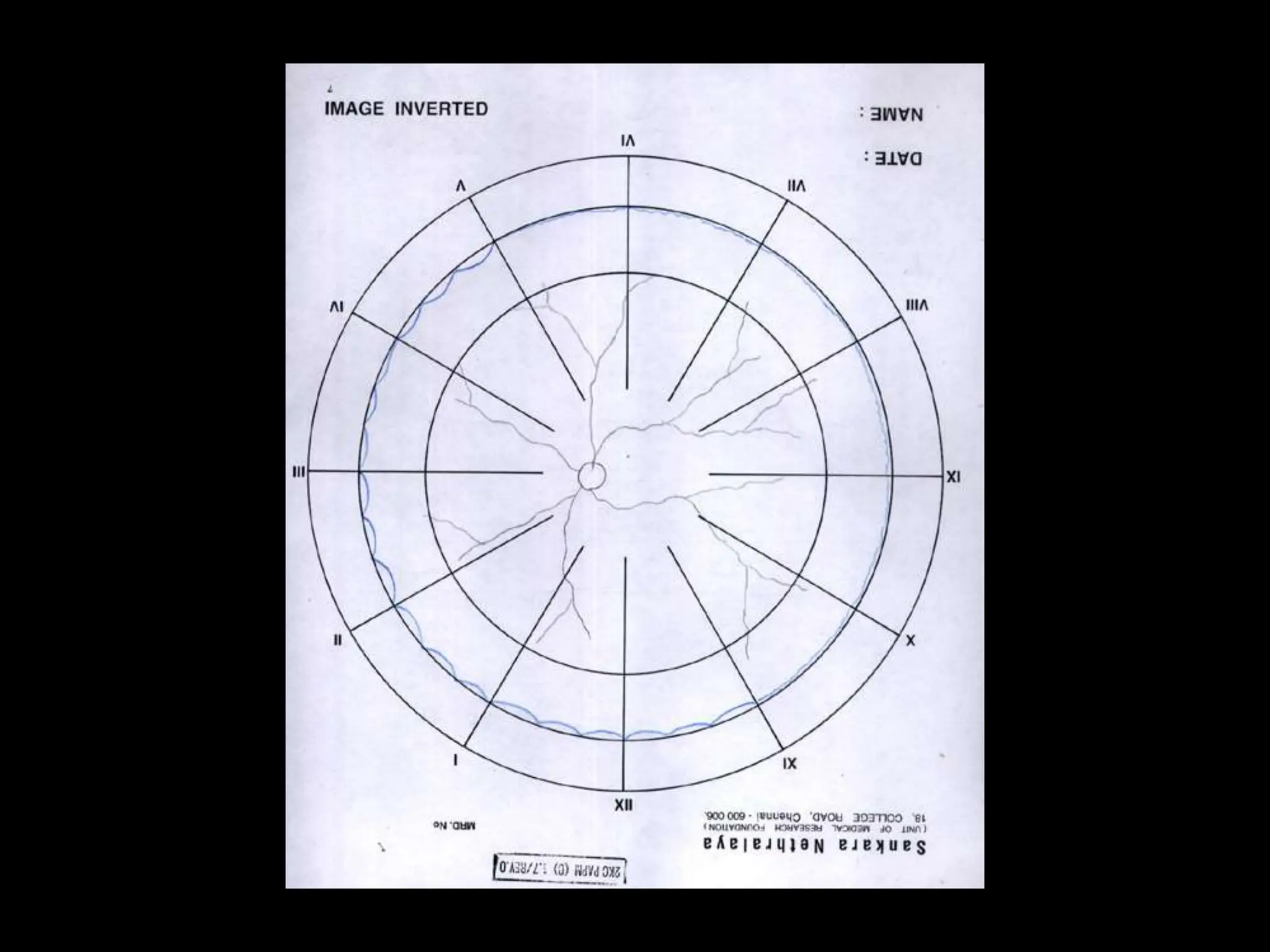 1FUNDUS_DRAWING of retina after complete examination | PPT