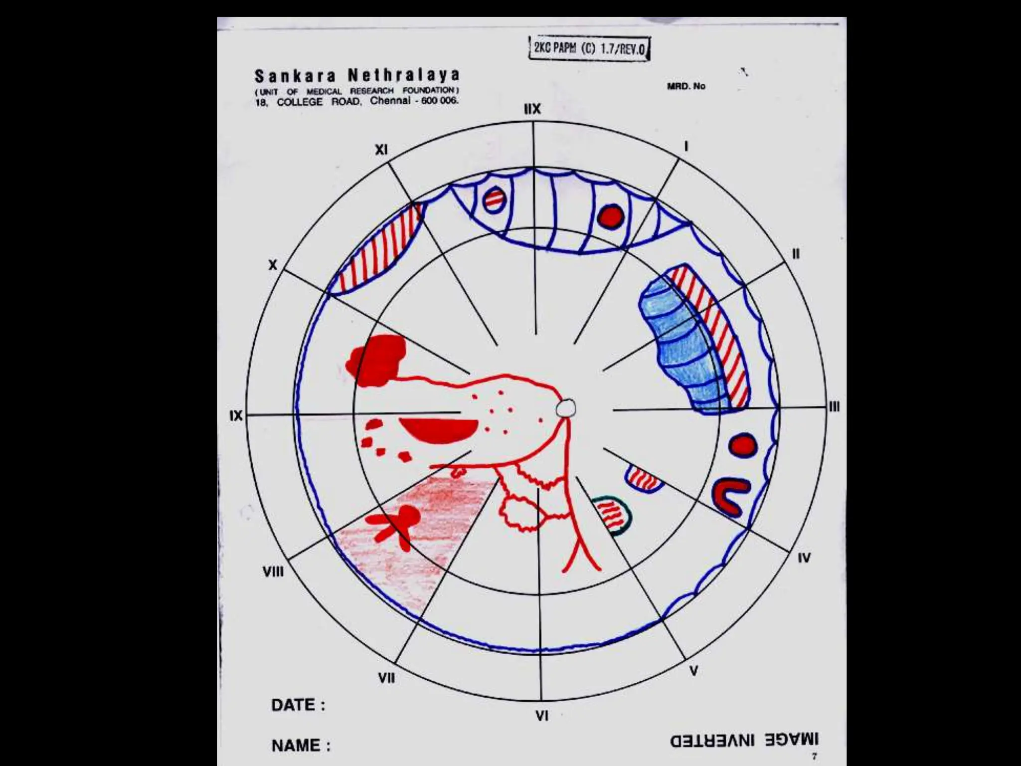 1FUNDUS_DRAWING of retina after complete examination | PPT
