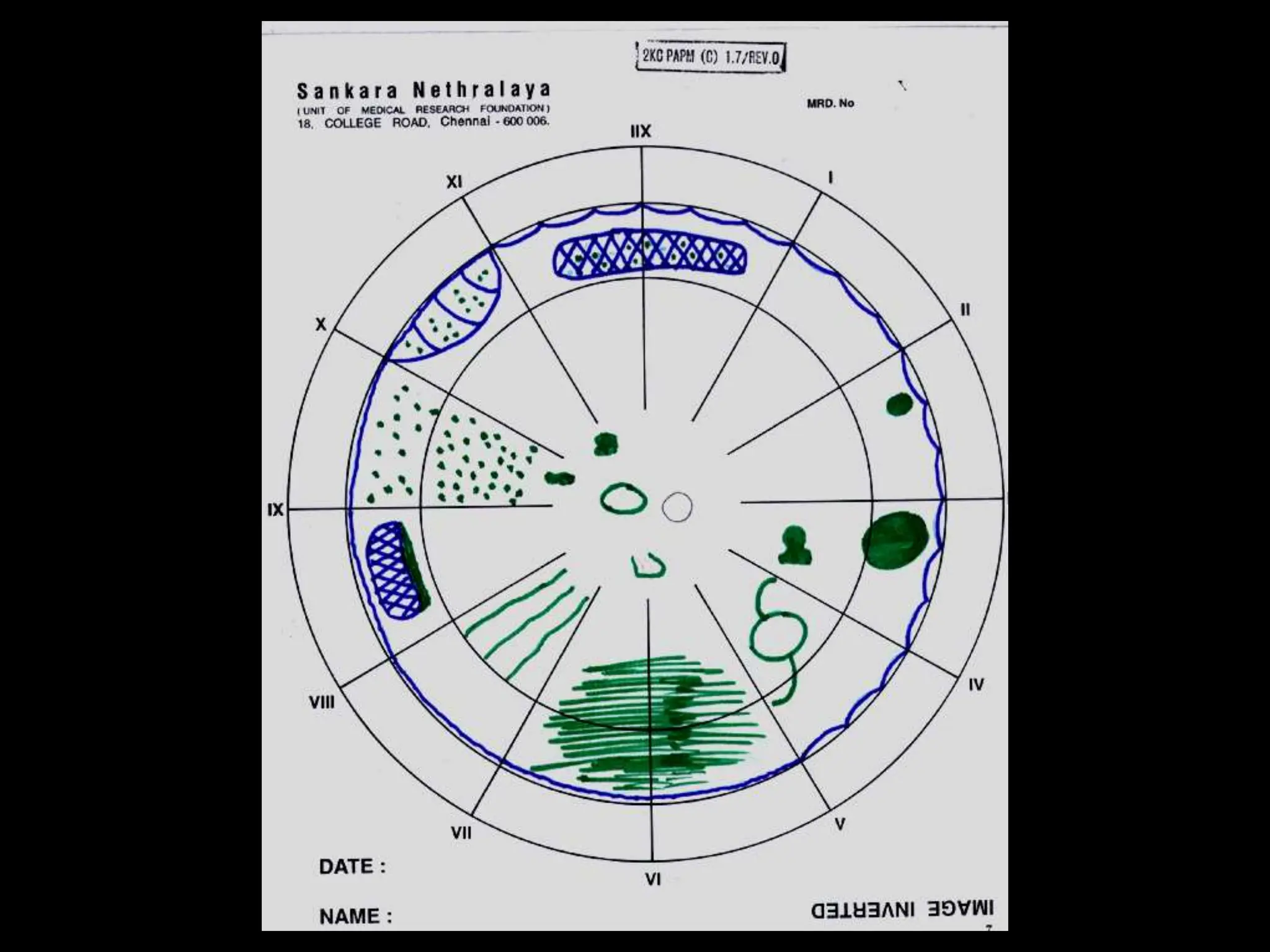 1FUNDUS_DRAWING of retina after complete examination | PPT