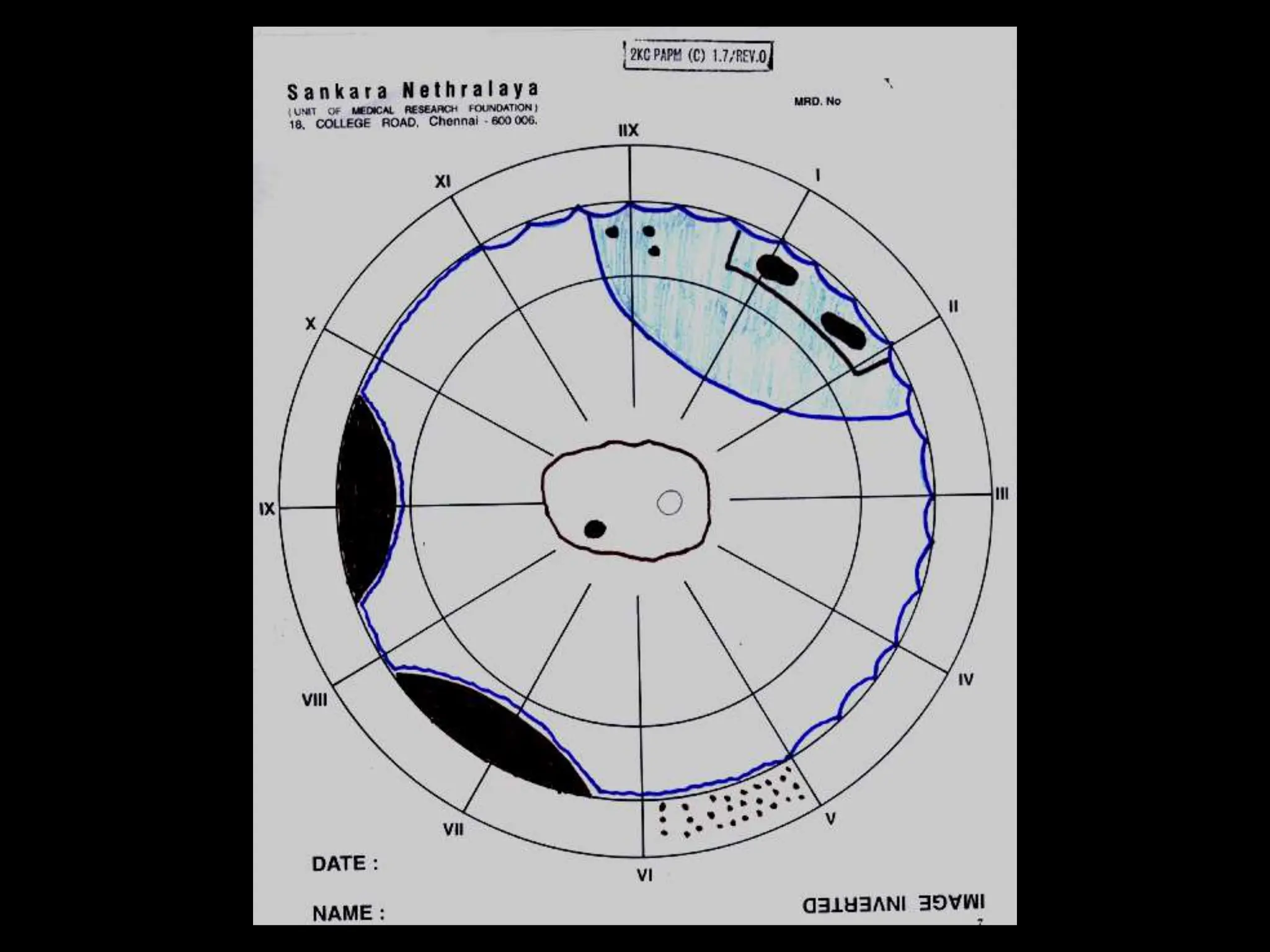 1FUNDUS_DRAWING of retina after complete examination | PPT